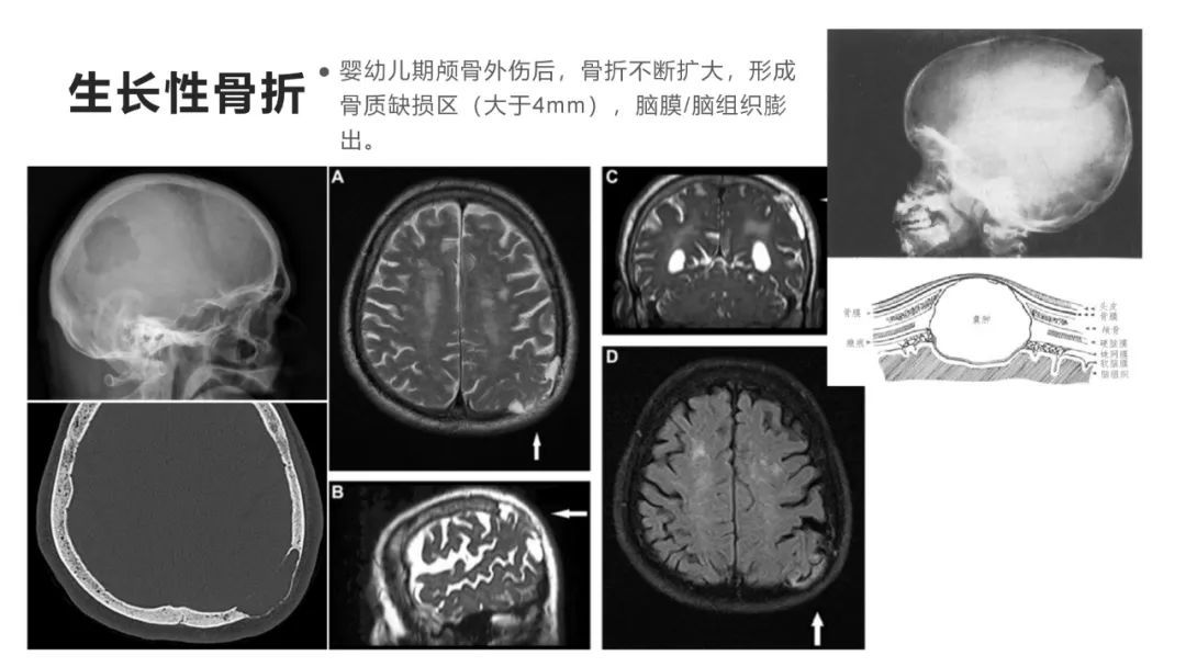 颅脑影像诊断基础知识讲座：颅骨病变 脑医汇