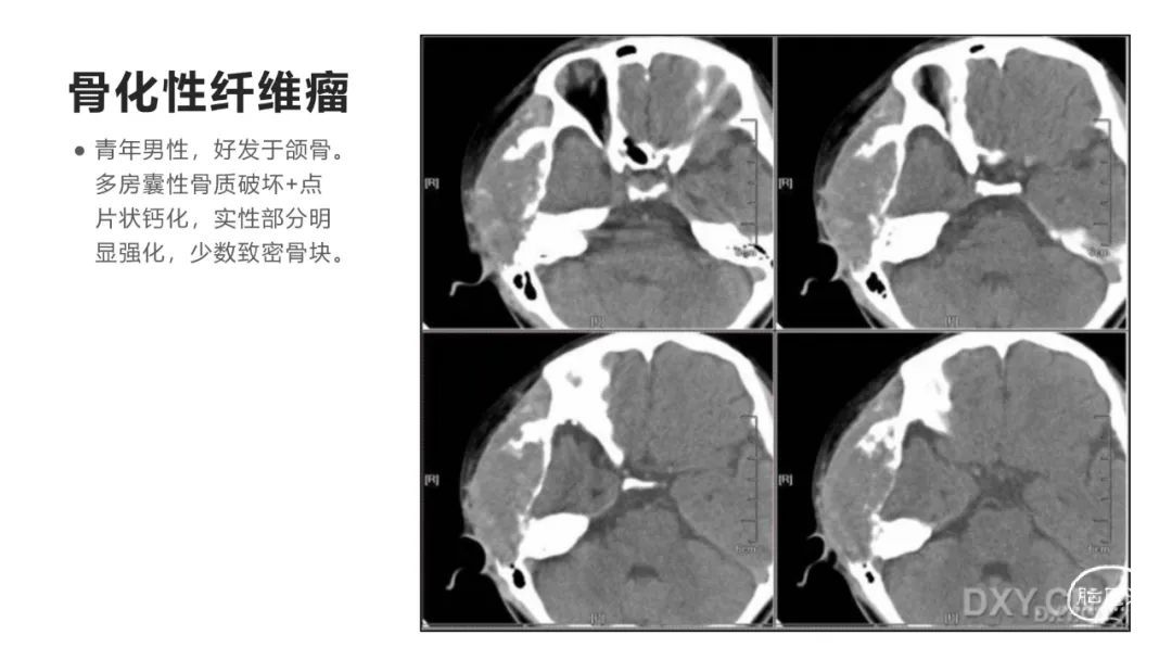 颅脑影像诊断基础知识讲座：颅骨病变 脑医汇
