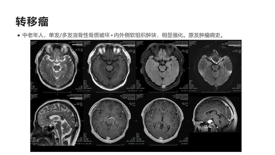 颅脑影像诊断基础知识讲座：颅骨病变 脑医汇