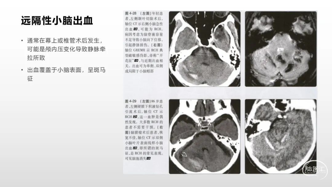 颅脑影像诊断基础知识讲座：《脑血管病》之出血、血管畸形、动脉炎及神经卡压 脑医汇 神外资讯 神介资讯