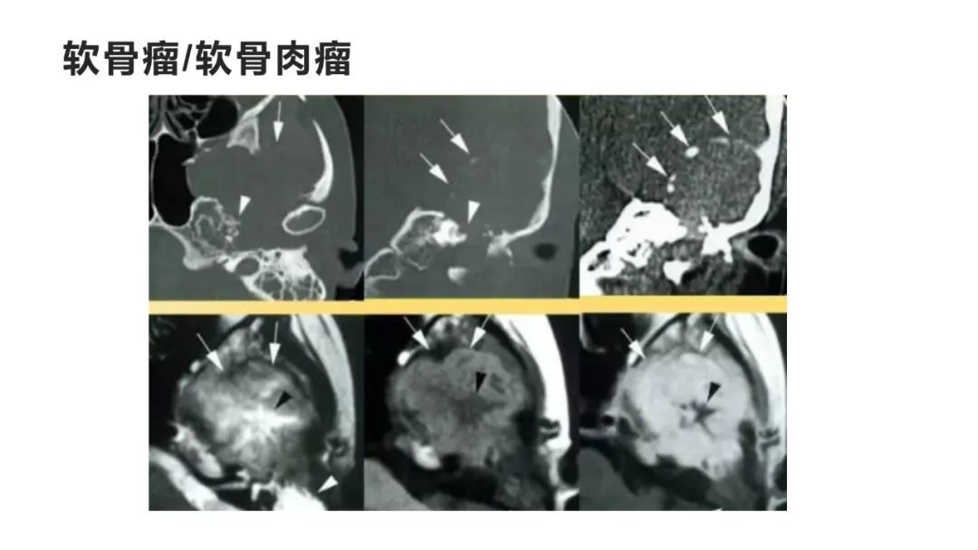 颅脑影像诊断基础知识讲座：颅骨病变 脑医汇