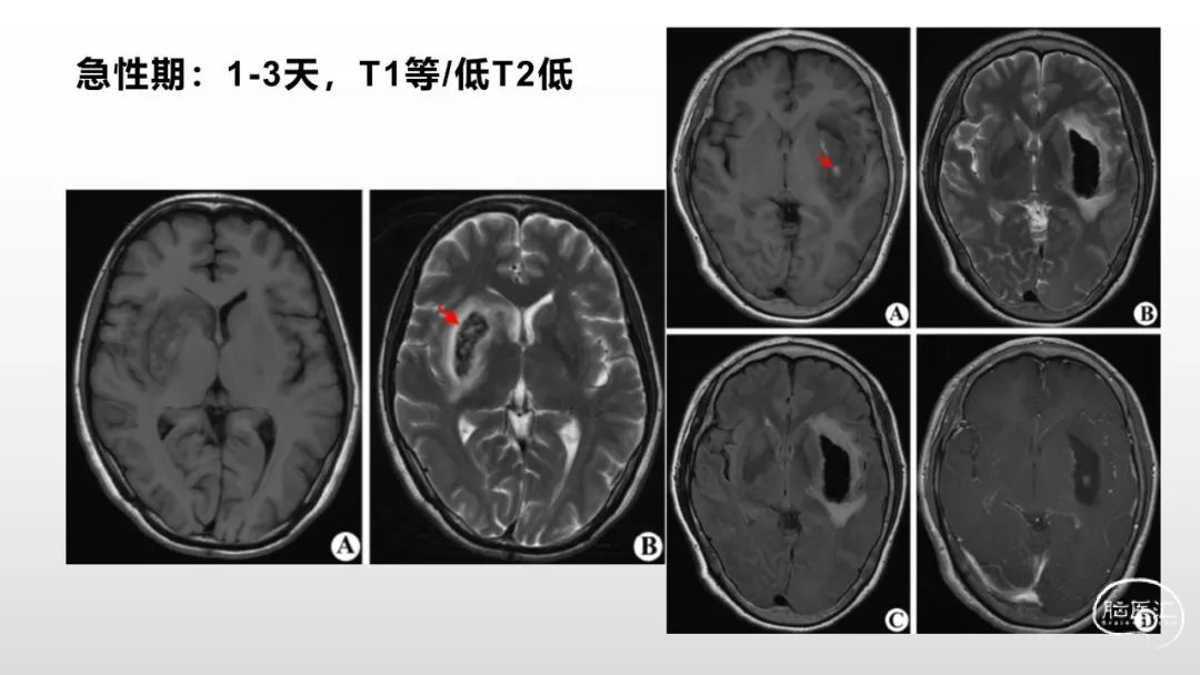 颅脑影像诊断基础知识讲座：《脑血管病》之出血、血管畸形、动脉炎及神经卡压 脑医汇 神外资讯 神介资讯