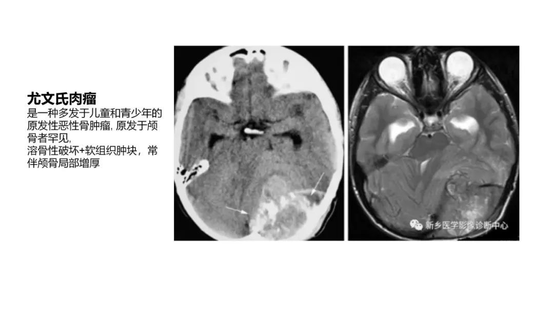 颅脑影像诊断基础知识讲座:颅骨病变 脑医汇