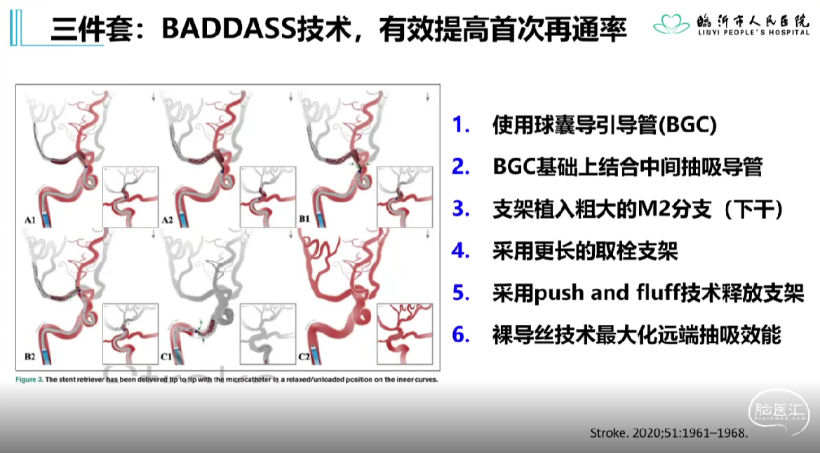 韩红星教授：复合取栓技术BADDASS详解 - 脑医汇