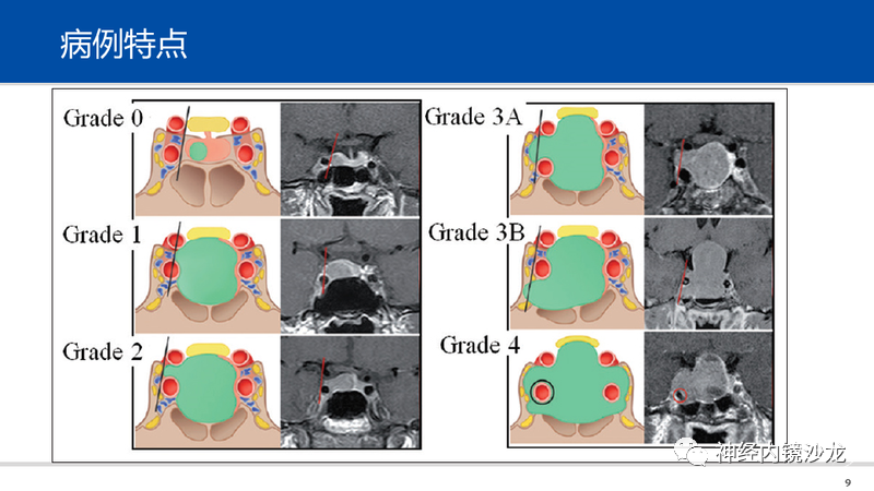 【病例】经鼻内镜海绵窦外侧入路切除Knosp-3B级生长激素腺瘤 - 脑医汇