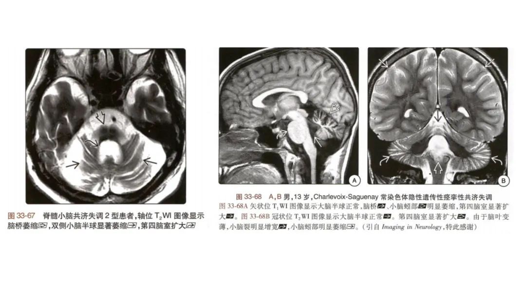 颅脑影像诊断基础知识讲座:脑退行性疾病 变性 脑医汇