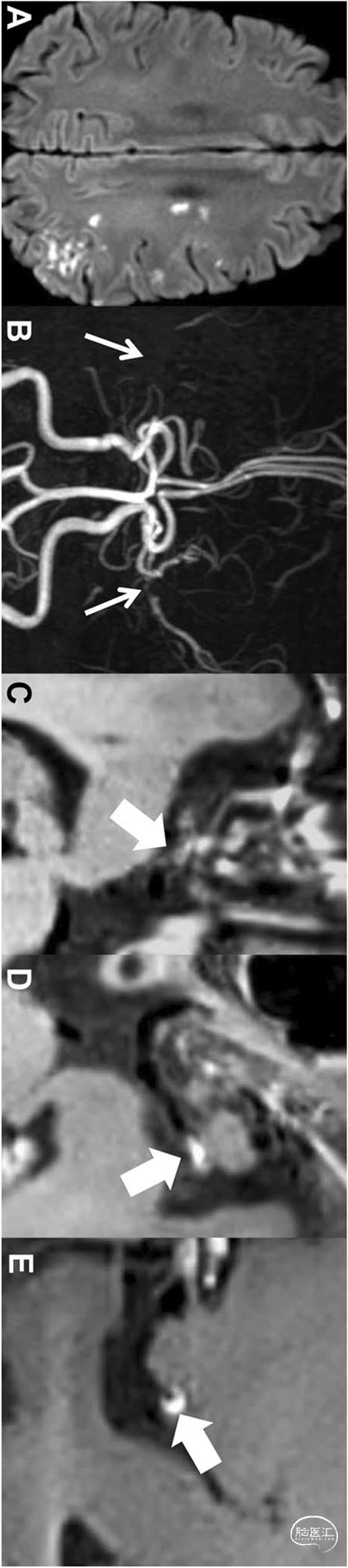 Neuroradiology：高分辨核磁在卒中病因分类中的价值 - 脑医汇