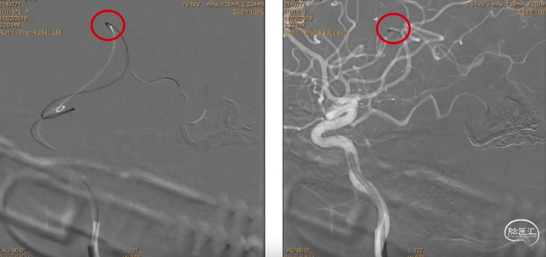 【病例记录】介入栓塞脑AVM并发症 - 脑医汇