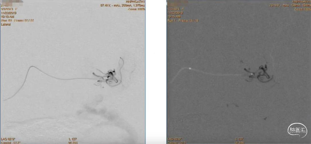 【病例记录】介入栓塞脑AVM并发症 - 脑医汇