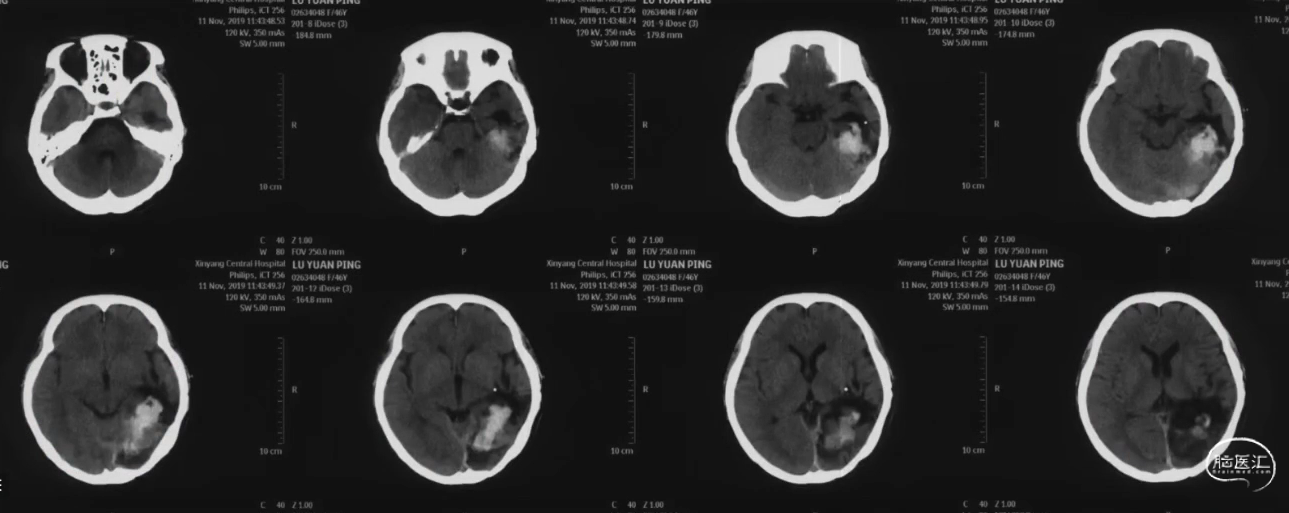 【病例记录】介入栓塞脑AVM并发症 - 脑医汇
