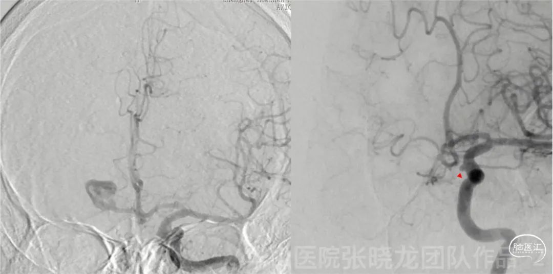 Stent Assisted Coiling of A1 Tandem Dissecting ANs with 5Y-FU - 脑医汇