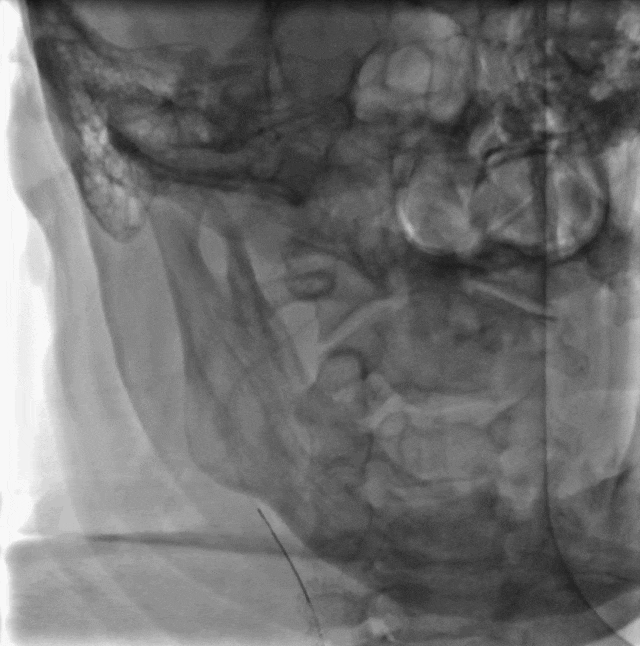 运用“EGS”经桡技术治疗右侧颈动脉狭窄一例 - 脑医汇
