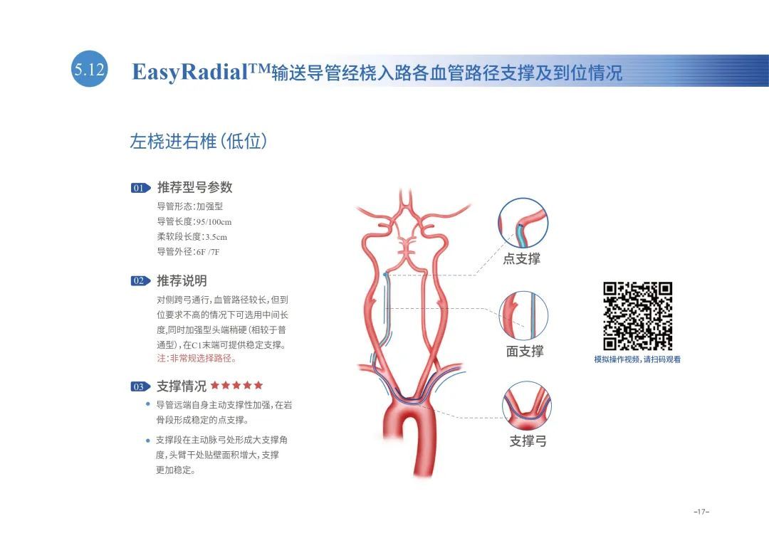 一文读懂,easyradial™输送导管如何实现guiding Solo( Egs”经桡技术续篇) 脑医汇 神外资讯 神介资讯