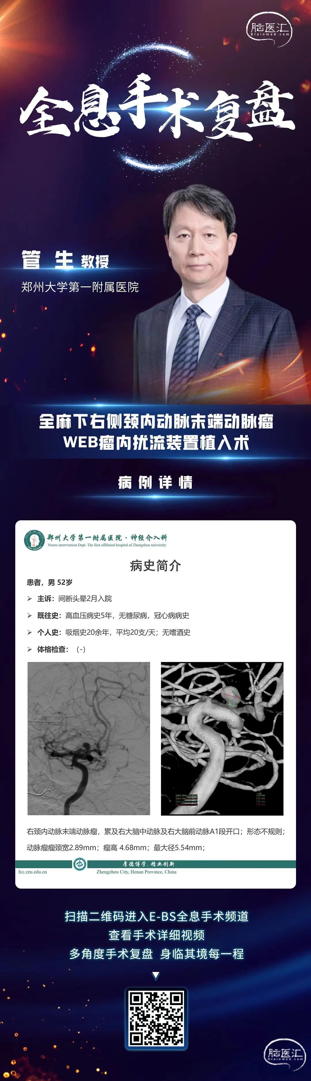 全息手术丨管生教授：全麻下右侧颈内动脉末端动脉瘤web瘤内扰流装置植入术一例 脑医汇 神外资讯 神介资讯