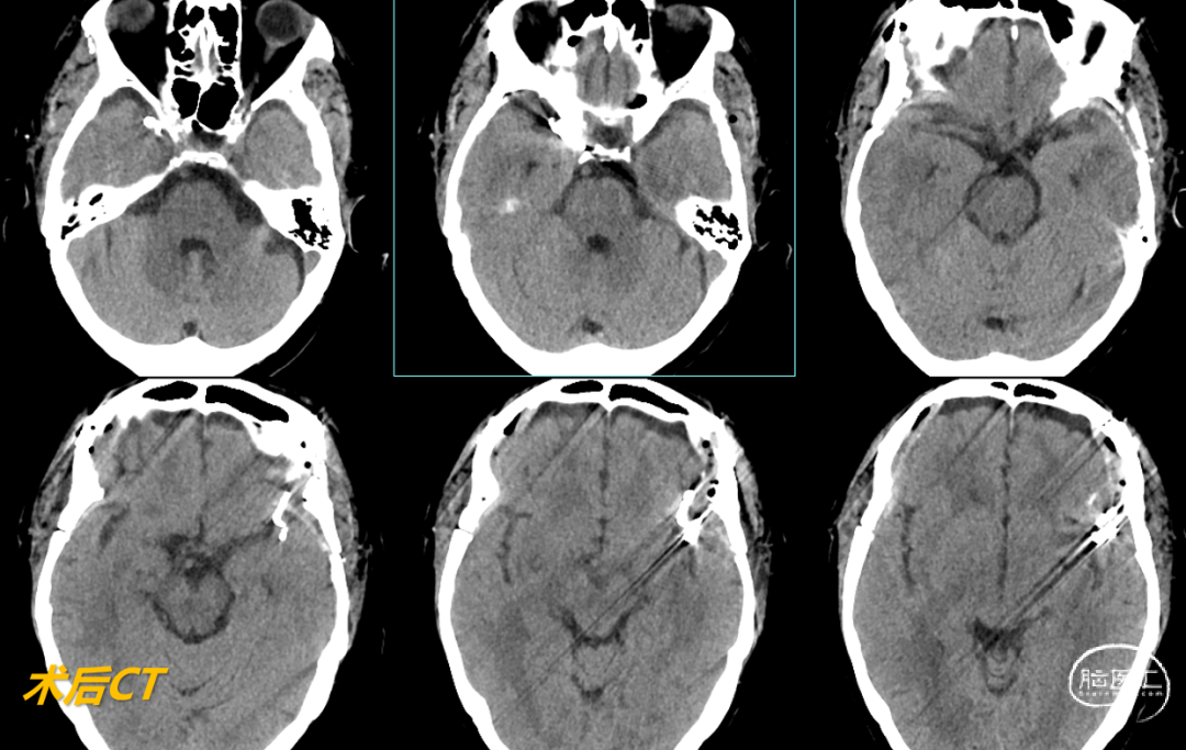 【病例分享】上海市一神外薛亚军团队：依旧快速康复，双侧 mini Pterion 入路夹闭双侧动脉瘤 - 脑医汇