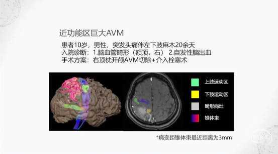 曹勇教授：功能区的AVM手术 | 云课堂推荐 - 脑医汇