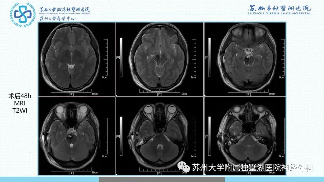 右侧颞下入路切除中脑桥脑海绵状血管瘤（巴教授手术精选第七期） - 脑医汇