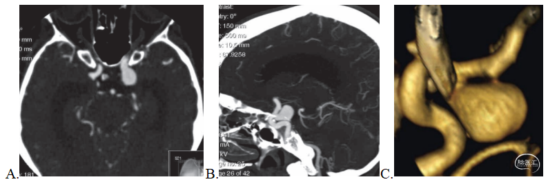 【经典连载】Ali Krisht教授：床突旁动脉瘤之PART 2——床突旁动脉瘤朝下型（腹侧动脉瘤） - 脑医汇 - 神外资讯 - 神介资讯