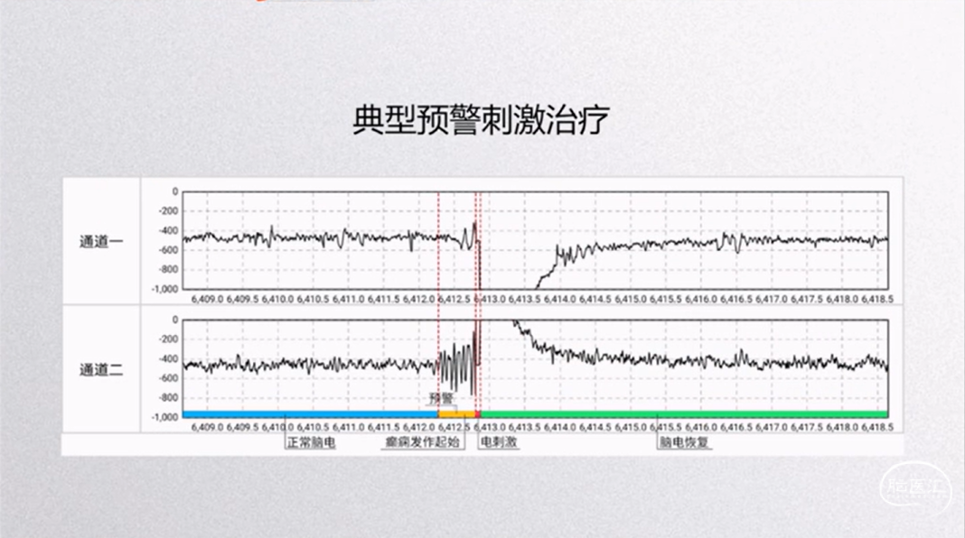 张建民教授:闭环神经调控治疗难治性癫痫临床转化研究 脑医汇