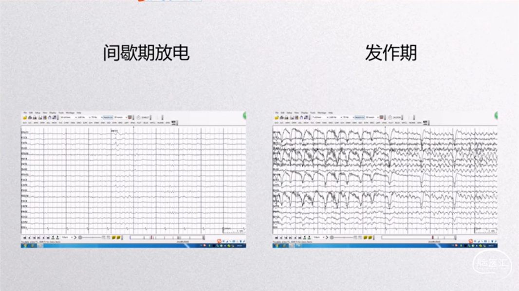 张建民教授:闭环神经调控治疗难治性癫痫临床转化研究 脑医汇