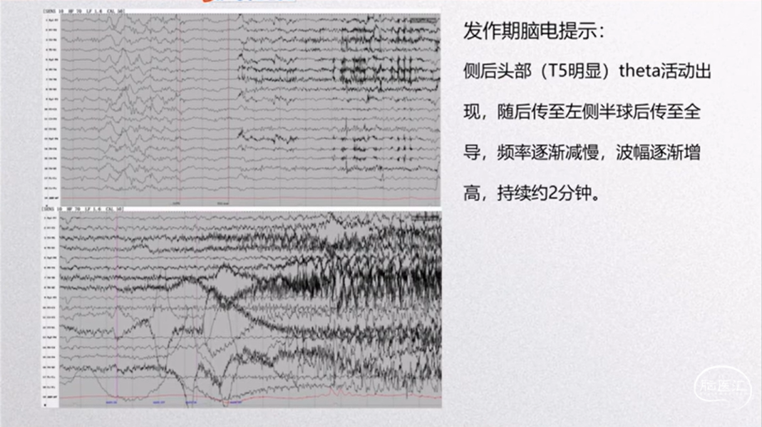 张建民教授:闭环神经调控治疗难治性癫痫临床转化研究 脑医汇