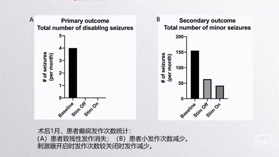 张建民教授:闭环神经调控治疗难治性癫痫临床转化研究 脑医汇