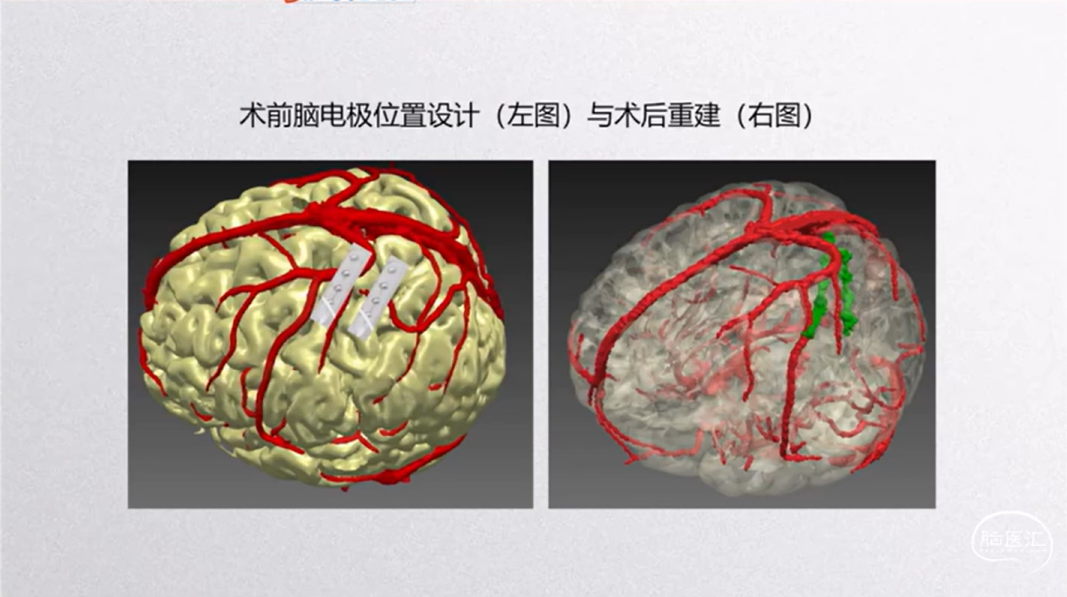 张建民教授:闭环神经调控治疗难治性癫痫临床转化研究 脑医汇