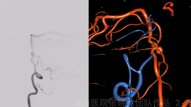 Basilar Artery Dissecting Aneurysm - 脑医汇