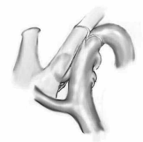 【经典连载】Ali Krisht教授：床突旁动脉瘤之PART 4——内侧型床突旁动脉瘤 - 脑医汇