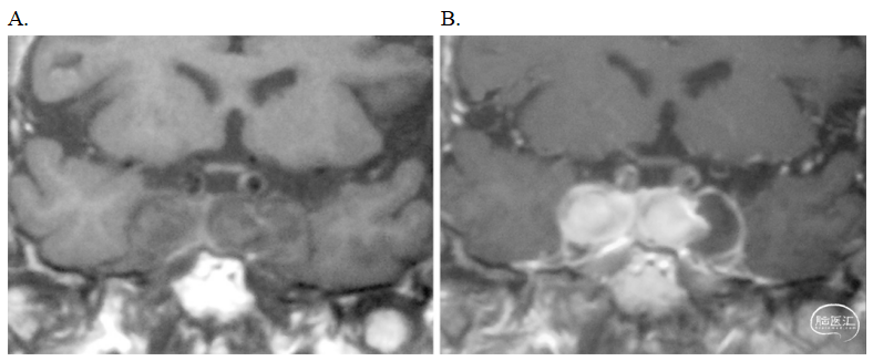 【经典连载】Ali Krisht教授：一例易误诊为垂体腺瘤卒中的双侧颈内动脉瘤病例报道 - 脑医汇