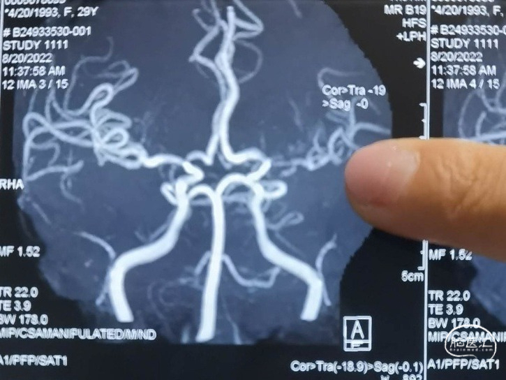 用神经内科医生的视角看SAMMPRIS与CASSISS研究 - 脑医汇