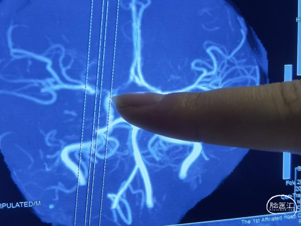 用神经内科医生的视角看SAMMPRIS与CASSISS研究 - 脑医汇