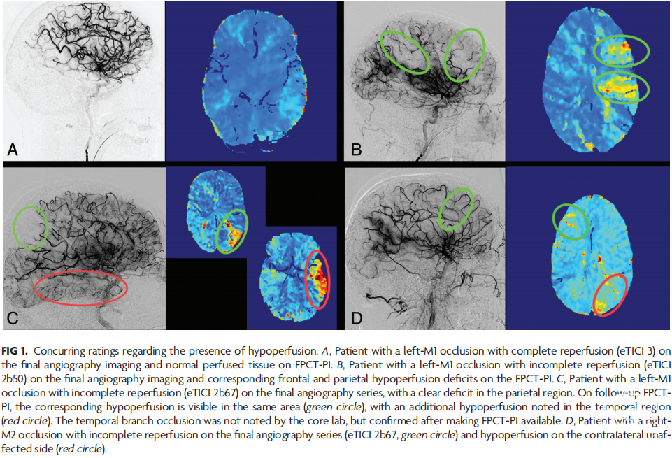 【精选编译】血管内治疗后即刻平板灌注成像的价值（AFTERMATH）——概念性验证研究 - 脑医汇