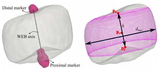 【精选编译】Woven Endo-Bridge（WEB）治疗颅内动脉瘤后的改变：一种形态和相对位置变化的三维分析方法 - 脑医汇