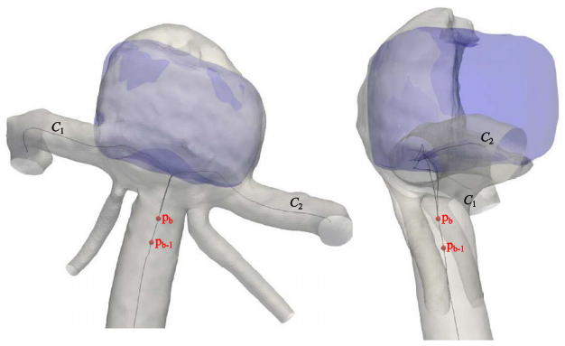 【精选编译】Woven Endo-Bridge（WEB）治疗颅内动脉瘤后的改变：一种形态和相对位置变化的三维分析方法 - 脑医汇