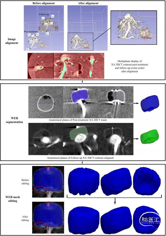 【精选编译】Woven Endo-Bridge（WEB）治疗颅内动脉瘤后的改变：一种形态和相对位置变化的三维分析方法 - 脑医汇