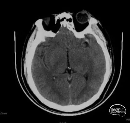 【随访：术后六个月】Surpass Evolve支架治疗Willis远端M2动脉瘤 - 脑医汇