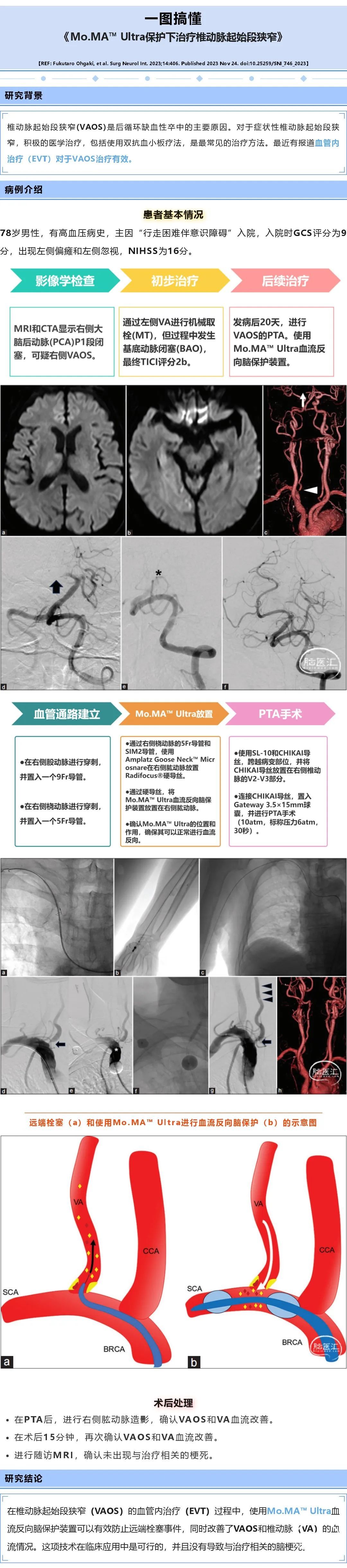 【一图搞懂】Mo.MA™ Ultra保护下治疗椎动脉起始段狭窄 - 脑医汇