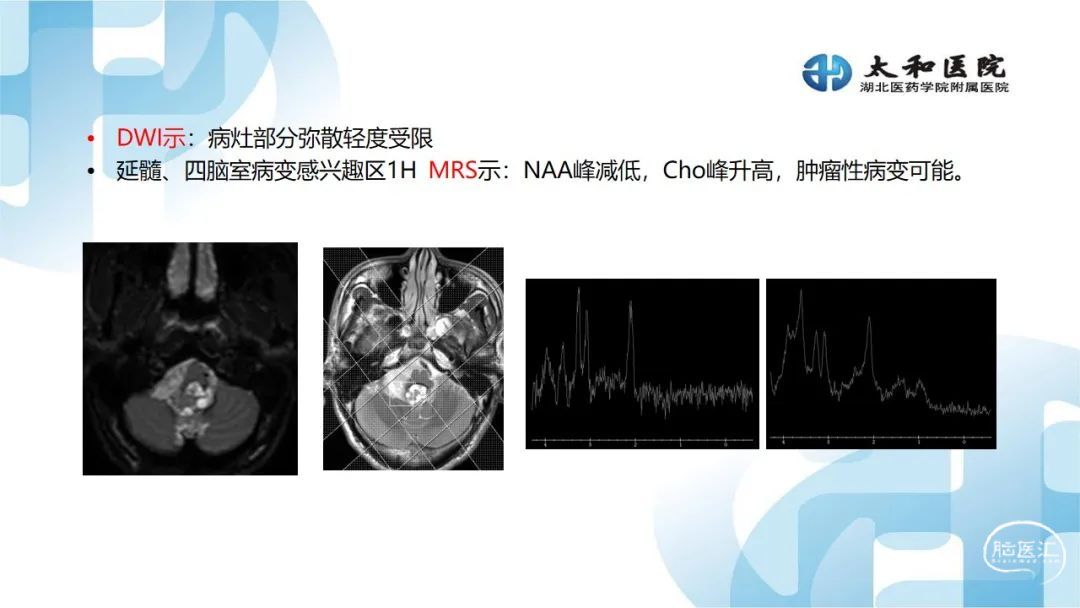 【病例分享】第六届全国胶质瘤大会——胶质瘤病例分享讨论会优秀病例展示(一) 脑医汇 神外资讯 神介资讯