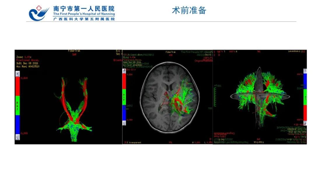 【病例分享】第六届全国胶质瘤大会——胶质瘤病例分享讨论会优秀病例展示(二) 脑医汇