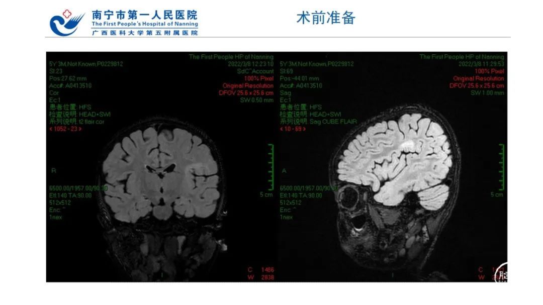 【病例分享】第六届全国胶质瘤大会——胶质瘤病例分享讨论会优秀病例展示(二) 脑医汇