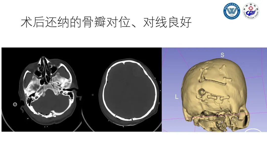 监测有道 枕骨骨折致横窦出血引起幕上下硬膜外血肿手术1例——颅脑创伤 神经重症周刊(第368期) 脑医汇