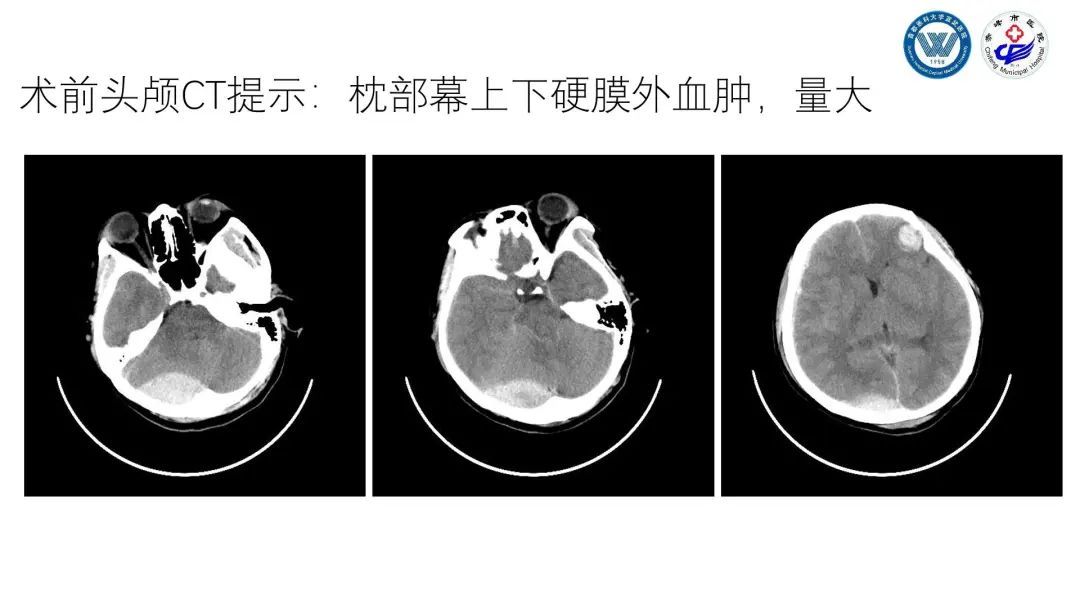 监测有道 枕骨骨折致横窦出血引起幕上下硬膜外血肿手术1例——颅脑创伤 神经重症周刊（第368期） 脑医汇 神外资讯 神介资讯