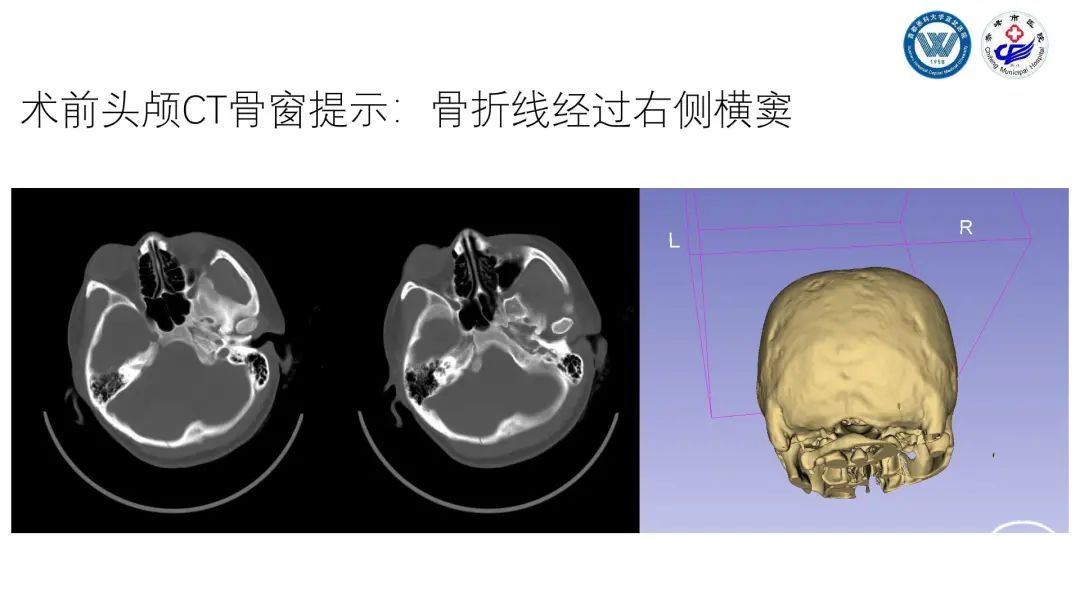 监测有道 枕骨骨折致横窦出血引起幕上下硬膜外血肿手术1例——颅脑创伤 神经重症周刊（第368期） 脑医汇 神外资讯 神介资讯