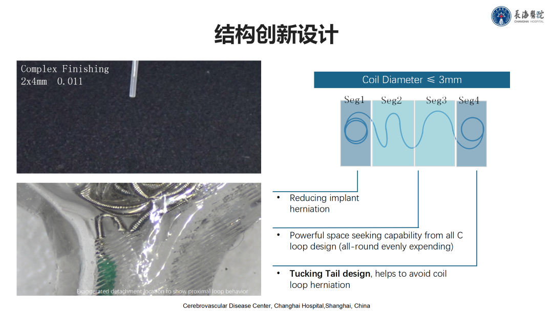 SNF-ALICE | Avenir Family Coil的动脉瘤治疗新选择 - 脑医汇