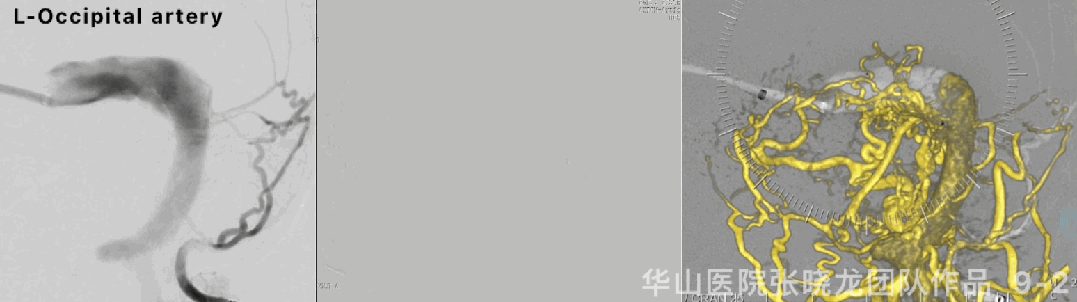 Staged management of bilateral DAVFs-Part Two - 脑医汇