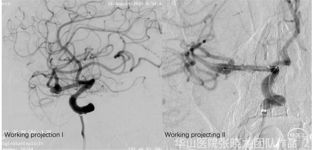 Post large coil stenting technique of R-MCA Dissecting AN - 脑医汇 - 神外资讯 ...