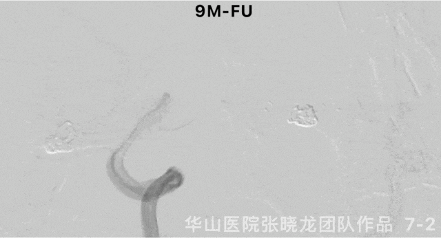 Post large coil stenting technique of R-MCA Dissecting AN - 脑医汇