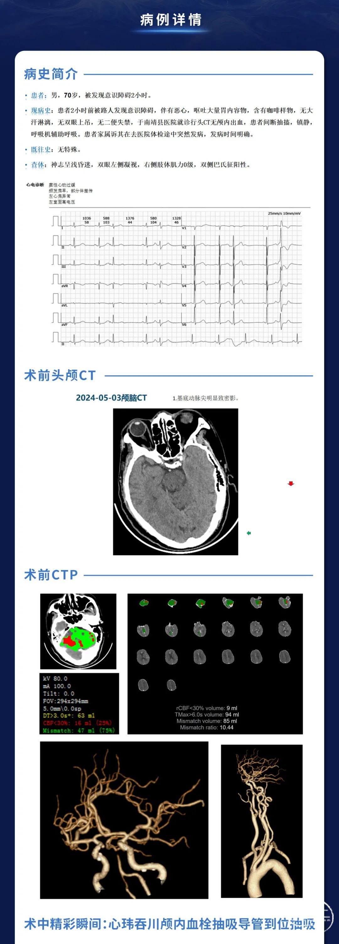 【全景手术】远大计划 易婷玉团队：心玮吞川6f颅内血栓抽吸导管应用于基底动脉闭塞取栓一例 脑医汇 神外资讯 神介资讯
