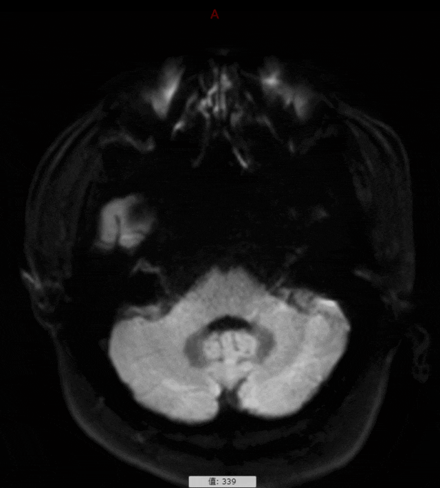 【通桥•通观全局】一例低NIHSS评分大负荷血栓致颈总-颈内动脉闭塞病例取栓回顾 - 脑医汇